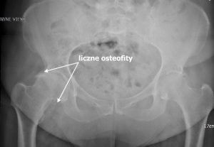 Widoczne zmiany na zdjęciach radiologicznych – ORTOPEDA BORKOWSKI