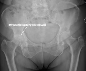 Widoczne zmiany na zdjęciach radiologicznych – ORTOPEDA BORKOWSKI