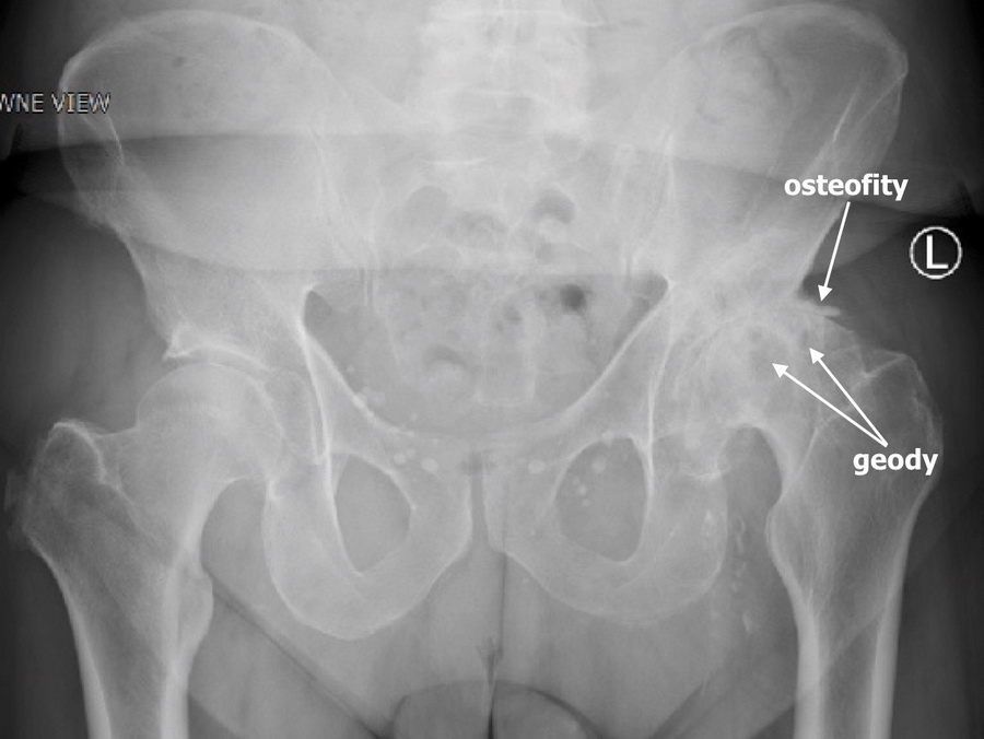 Widoczne zmiany na zdjęciach radiologicznych – ORTOPEDA BORKOWSKI